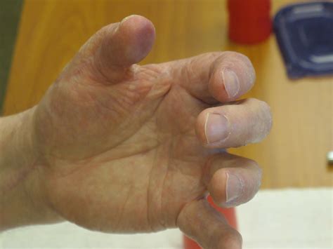 Surgeons Having More Success Reattaching Fingers And Thumbs