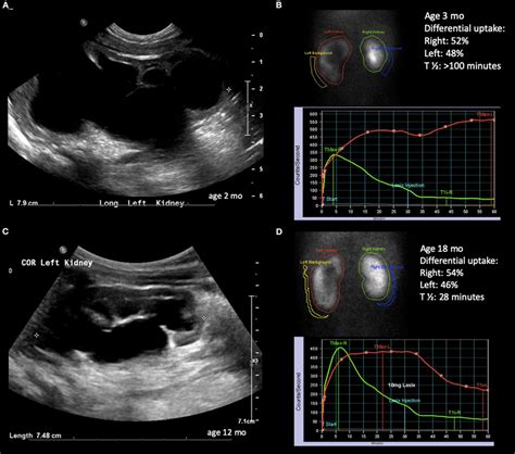 Radiological History Of An Infant With Severe Hydronephrosis Secondary