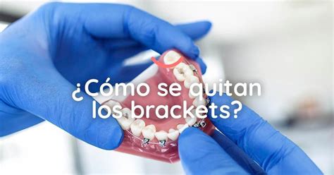 Cómo se quitan los brackets