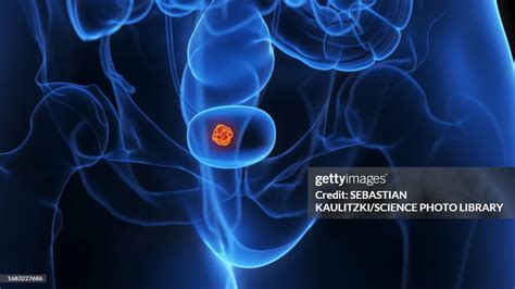 Bladder Tumour Illustration High Res Vector Graphic Getty Images