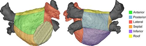 Sex Related Differences In Atrial Remodeling In Patients With Atrial