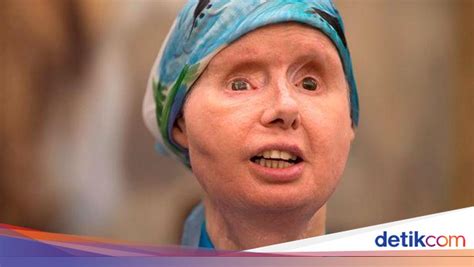 Transformasi Wanita Diserang Simpanse Hingga Wajah Rusak Tak Berbentuk