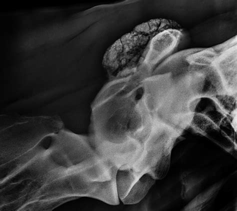 Ligamentum Nuchae Calcification