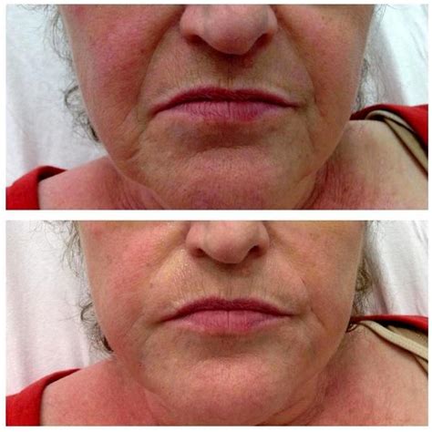 Marionette Lines Botox Before And After Pictures 1 Facial