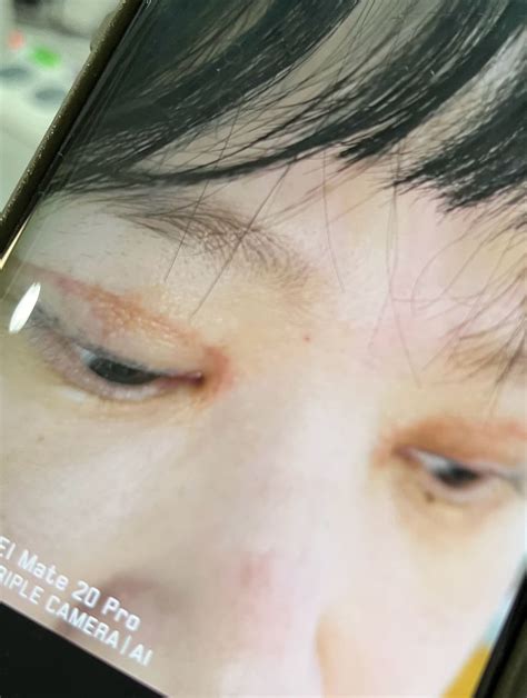 詢問 雙眼皮疤痕 醫美板 Dcard