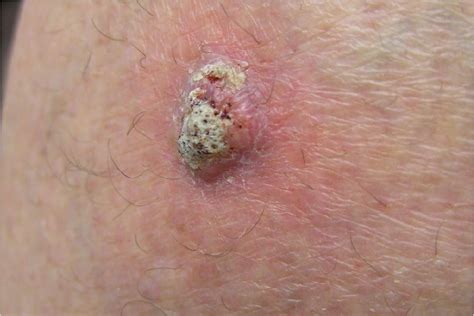 Squamous Cell Carcinoma Treatment