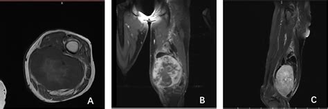 Liposarcoma Radiology Imaging Of Liposarcoma Classification Patterns