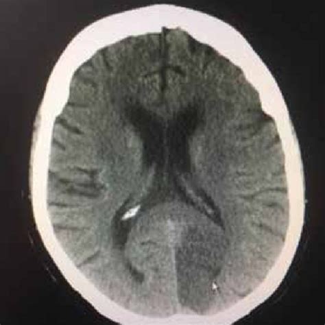 Ctscan Brain Showing Left Occipital Infarct Her Anaemia Was