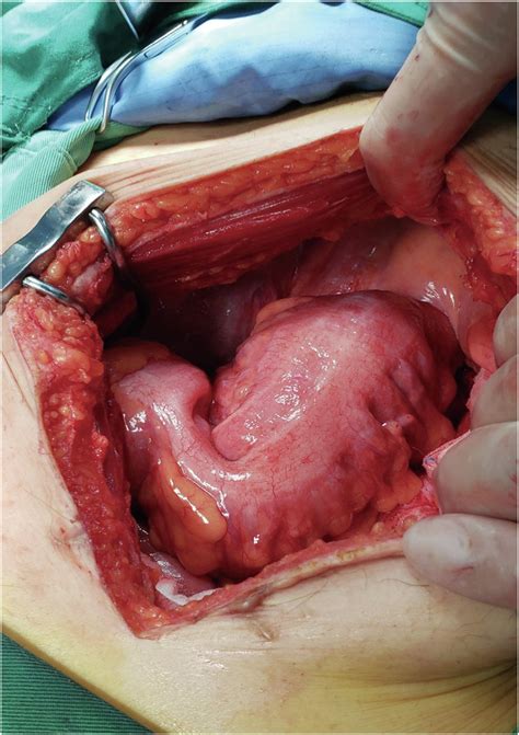 A Second Open Abdomen Operation Reveals Severe Adhesion Between The New