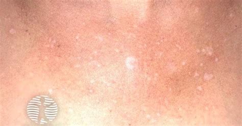 Guttate Morphoea Image