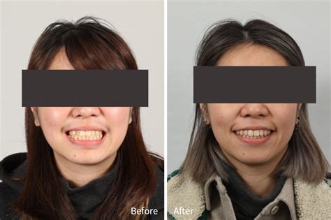 自鎖式矯正案例 牙齒擁擠前牙錯咬左下大臼齒缺損 27歲女 郭根榮醫師