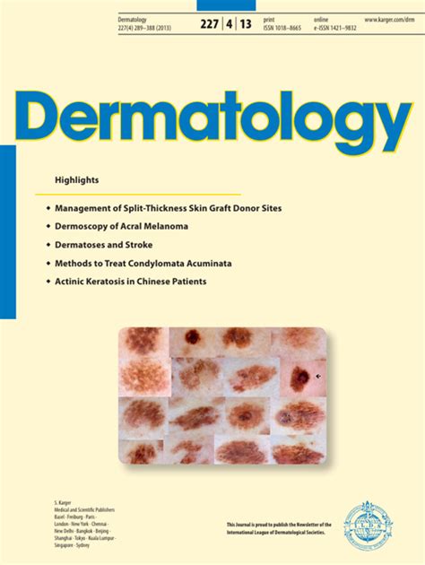 Primary Cutaneous Anaplastic Large Cell Lymphoma With Angioinvasive