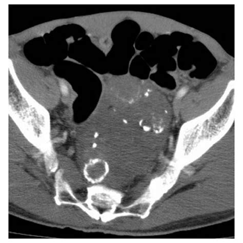 A Cut Surface Of The Tumor Shows Encapsulated Solid Mass Containing Download Scientific