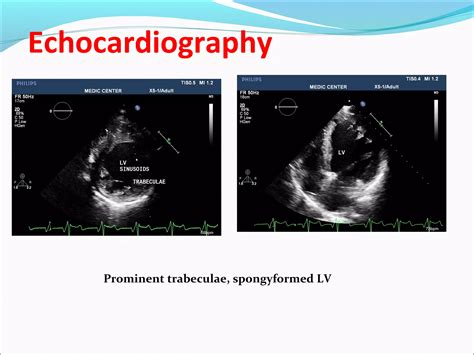 Noncompaction Cardiomyopathy Nguyen Tuan Vu Nguyen Thi Kim Sang Duong Phi Son Phan Thanh Hai