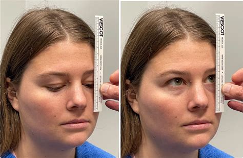 Ptosis Evaluation For Otolaryngologists Otolaryngologic Clinics Of