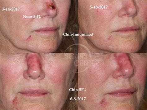Superficial Basal Cell Carcinoma Nose