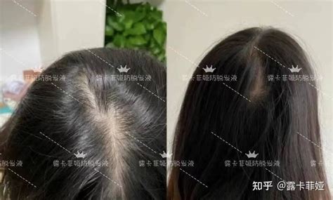 头发精华液真的能生发吗 5款高口碑防脱 知乎