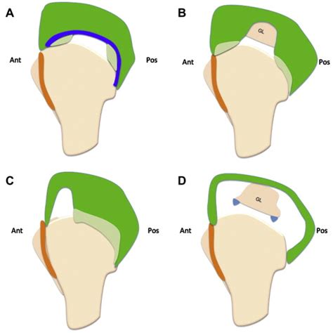 The Rotator Cable Magnetic Resonance Evaluation And Clinical