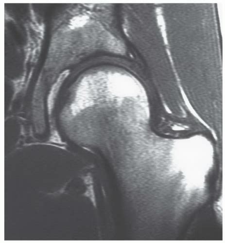 Diffuse Marrow Diseases Musculoskeletal Key