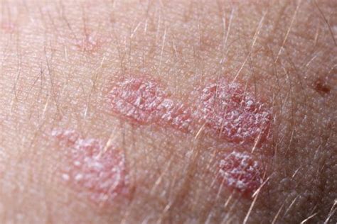 Inverse Lichen Planus