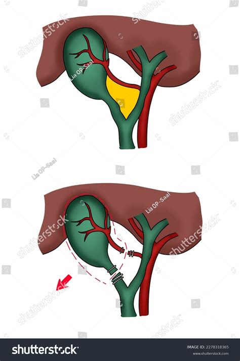 Gall Bladdler Cholecystectomie Calot Dreieckecalots Triangle Stock