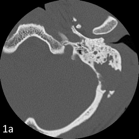 A Computed Tomography Of Temporal Bone Nonpneumatization Of Left Download Scientific Diagram