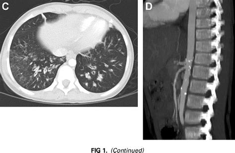 Figure 1 From Dominant Gain Of Function Stat1 Mutations In Foxp3 Wild Type Immune Dysregulation