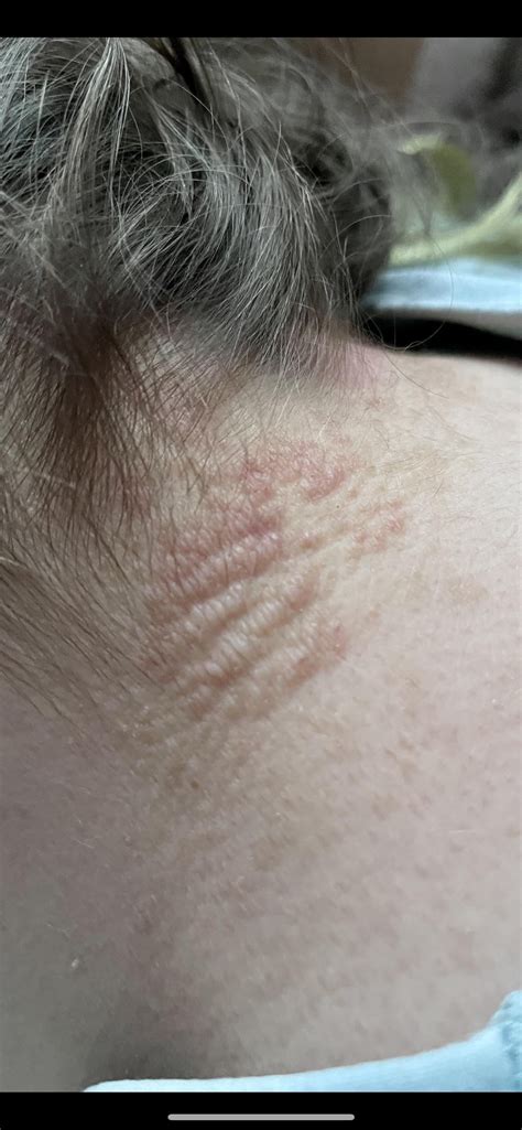 Does This Look Like Psoriasis I Have Psoriasis In My Scalp And I