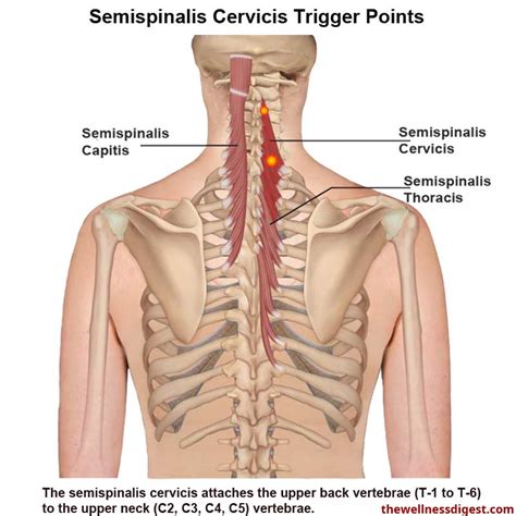 Splenius Capitis Trigger Points