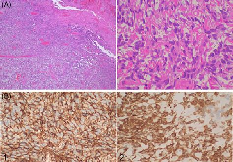 A Solitary Fibrous Tumour Our Patients Tumour Histological