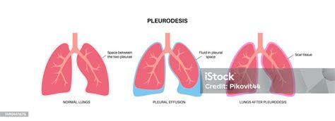 Pleurodesis Medical Procedure Stock Illustration Download Image Now