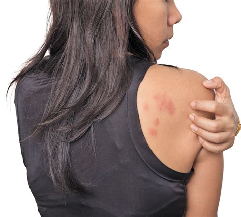 Why Won T My Hives Go Away Harvard Health