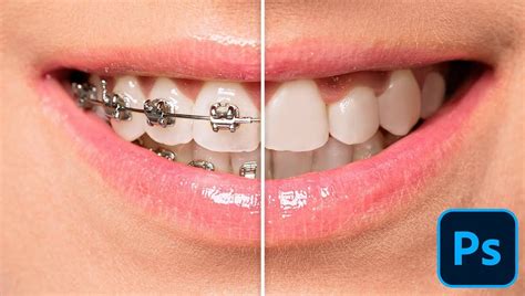 How To Remove Braces Using Photoshop Flipboard
