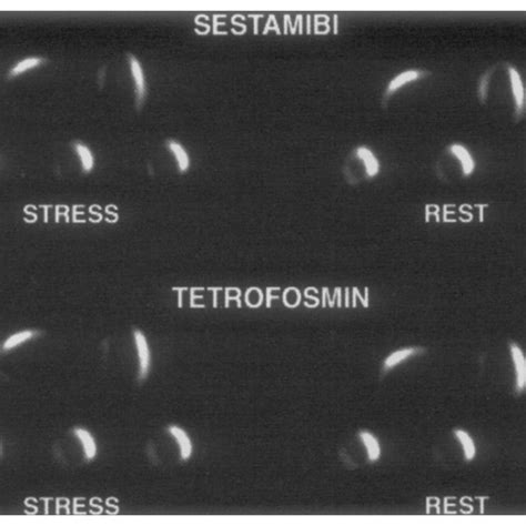 99mtc Labeled Sestamibi And Tetrofosmin Defects Severity At Visual And