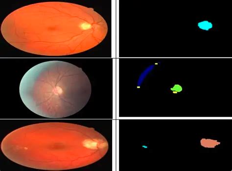 Github Ali Johnoptic Disc Extraction From Retinal Images