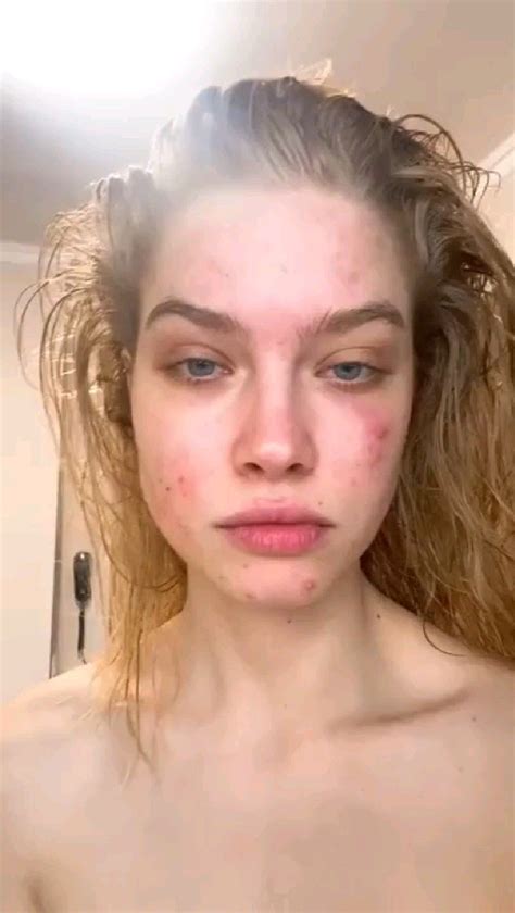 Hormonal Acne Treatment Artofit