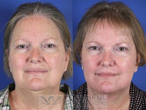 Co2 Laser Skin Resurfacing Before And After Photos Patient 58 Nashville