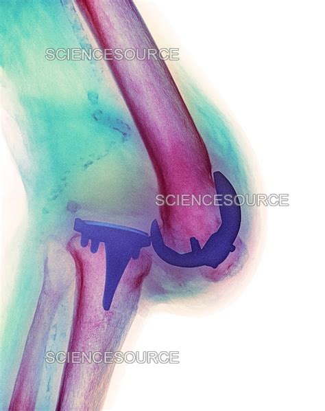 Dislocated Knee X Ray Stock Image Science Source Images