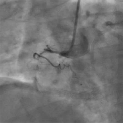 Totally Occluded Proximal Rca Which Is Calcified Download Scientific