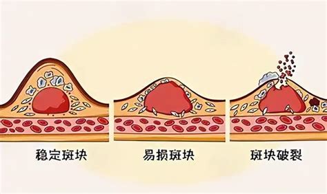 發現頸動脈斑塊，就離腦梗不遠了？醫生：做好3事，斑塊或可變小 每日頭條