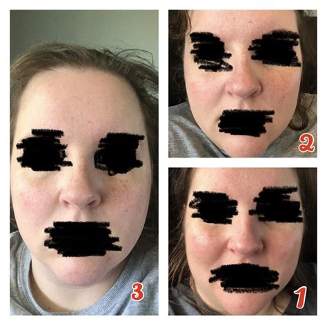 Sulfur Soap Before And After Bio Sulfur Review