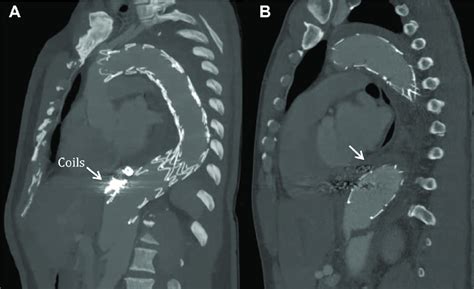 A One Year Status Post Thoracic Endovascular Aortic Repair Tevar And Download Scientific
