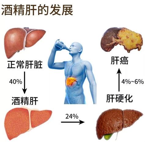 揭秘 酒精肝”的世界，它距离肝癌还远么 微医（挂号网）
