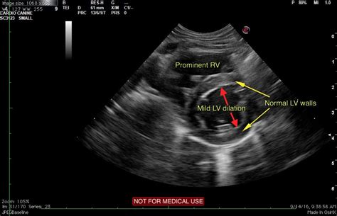 Mild Restrictive Cardiomyopathy Rcm With Mild Biatrial Enlargement In A 10 Year Old Fs Dsh Cat