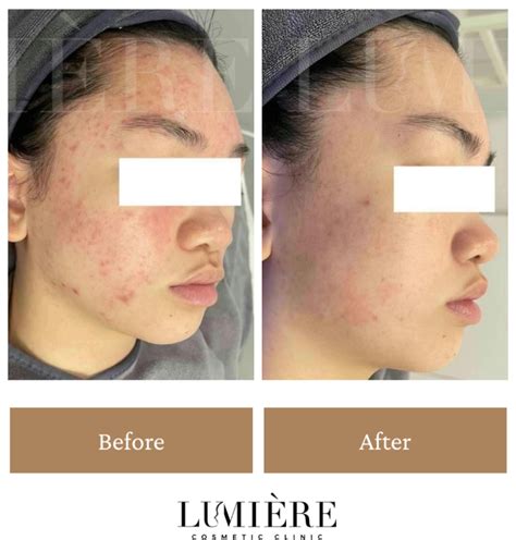 What Causes Acne And Effective Treatments Lumière Clinic