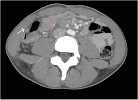 Abdominal Computed Tomography Scan With Positive Oral Intravenous Download Scientific Diagram
