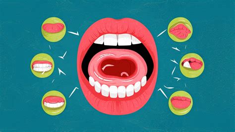Canker Sores Aphthous Ulcers Types Causes Symptoms And Management”