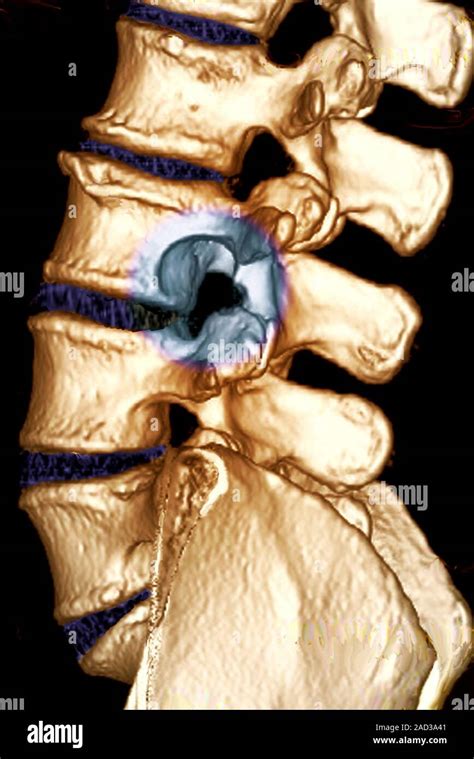 Spinal Tumour Coloured D Computed Tomography CT Scan Of The Lumbar Spine Of A Year Old