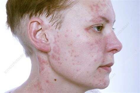 Allergic Reaction To Makeup On My Face Saubhaya Makeup