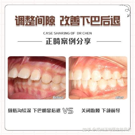 郑州牙齿矫正｜郑州正畸｜郑州整牙｜颌位重建｜改善下巴后退 知乎